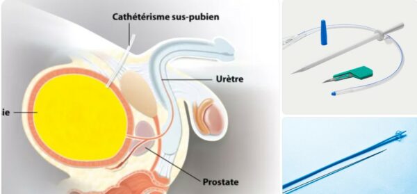Set de drainage sus-pubien Cystodrain® - medchariot